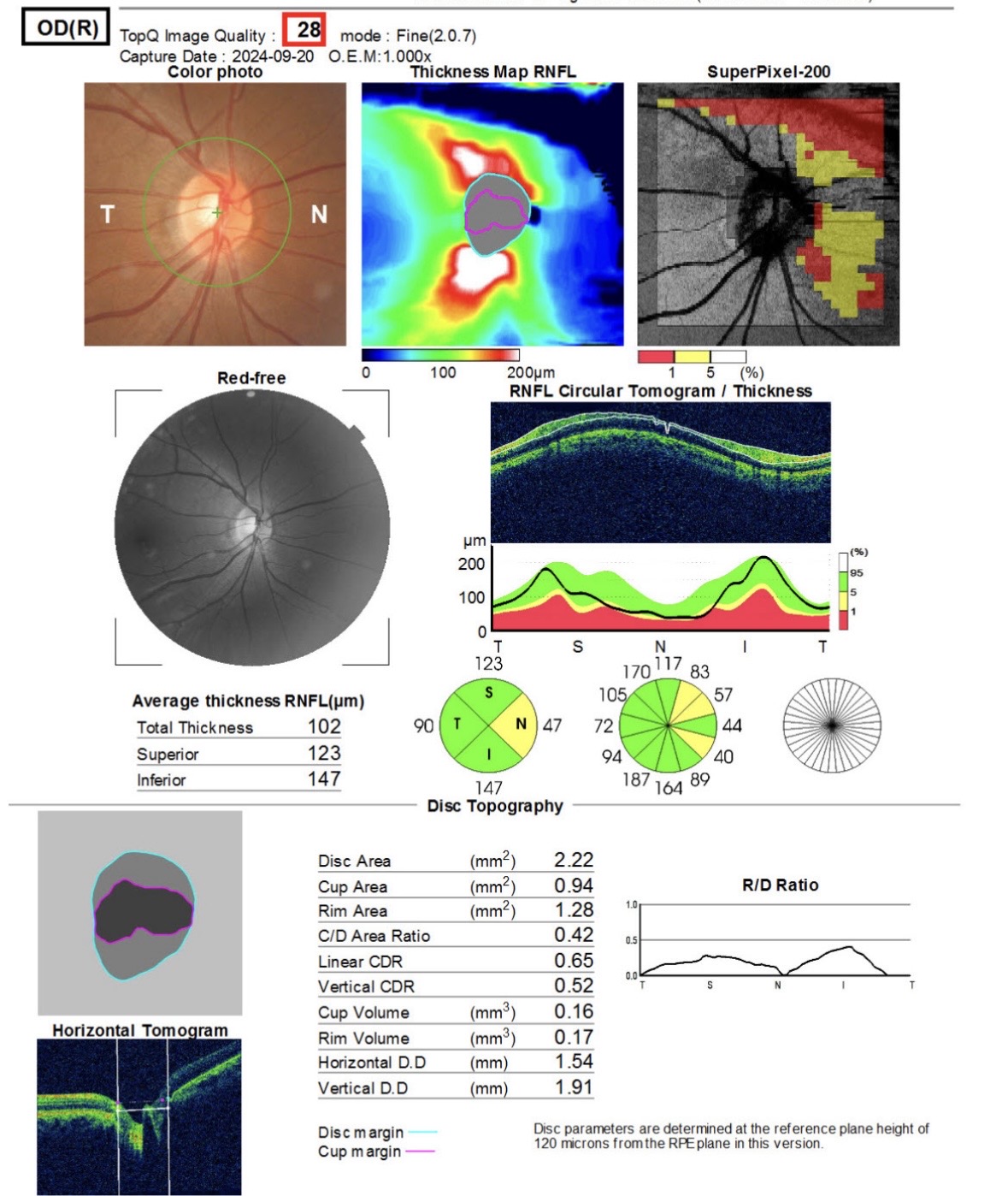 안과 Oct검사 빨간부분이 늘어났는데 괜찮은가요 ㅣ 궁금할 땐, 아하!
