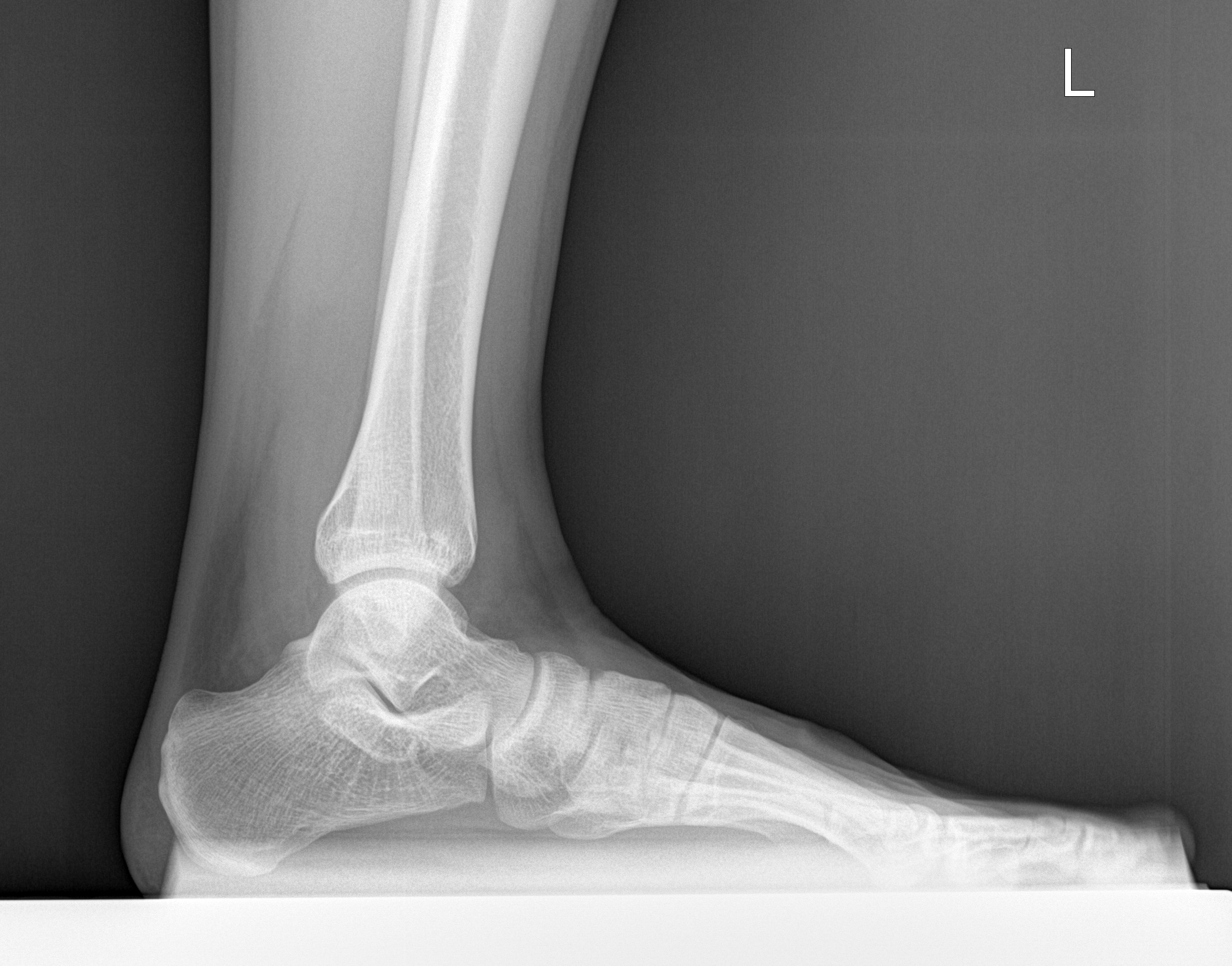 거골-제1중족골 각도 (Meary’s angle) 가 궁금합니다 ㅣ 궁금할 땐, 아하!